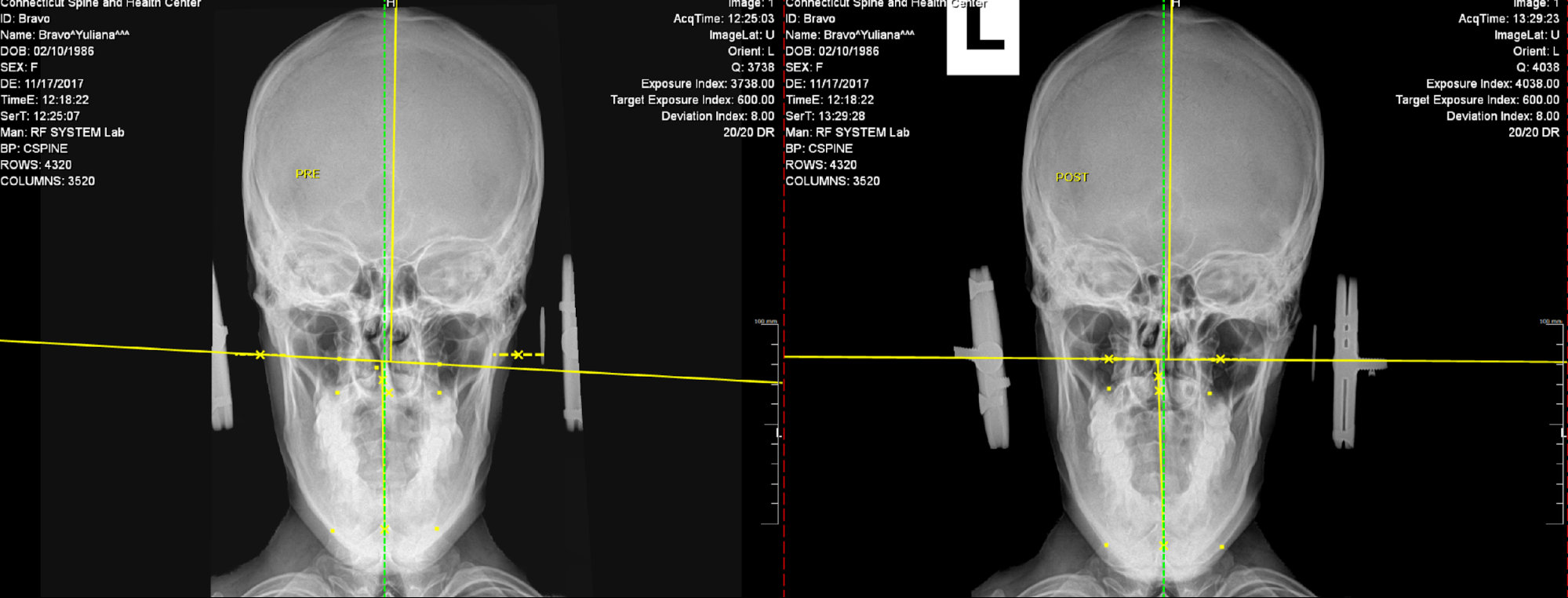 Ms. YB, Female, Age 31 - CT Spine Center | Upper Cervical Chiropractor
